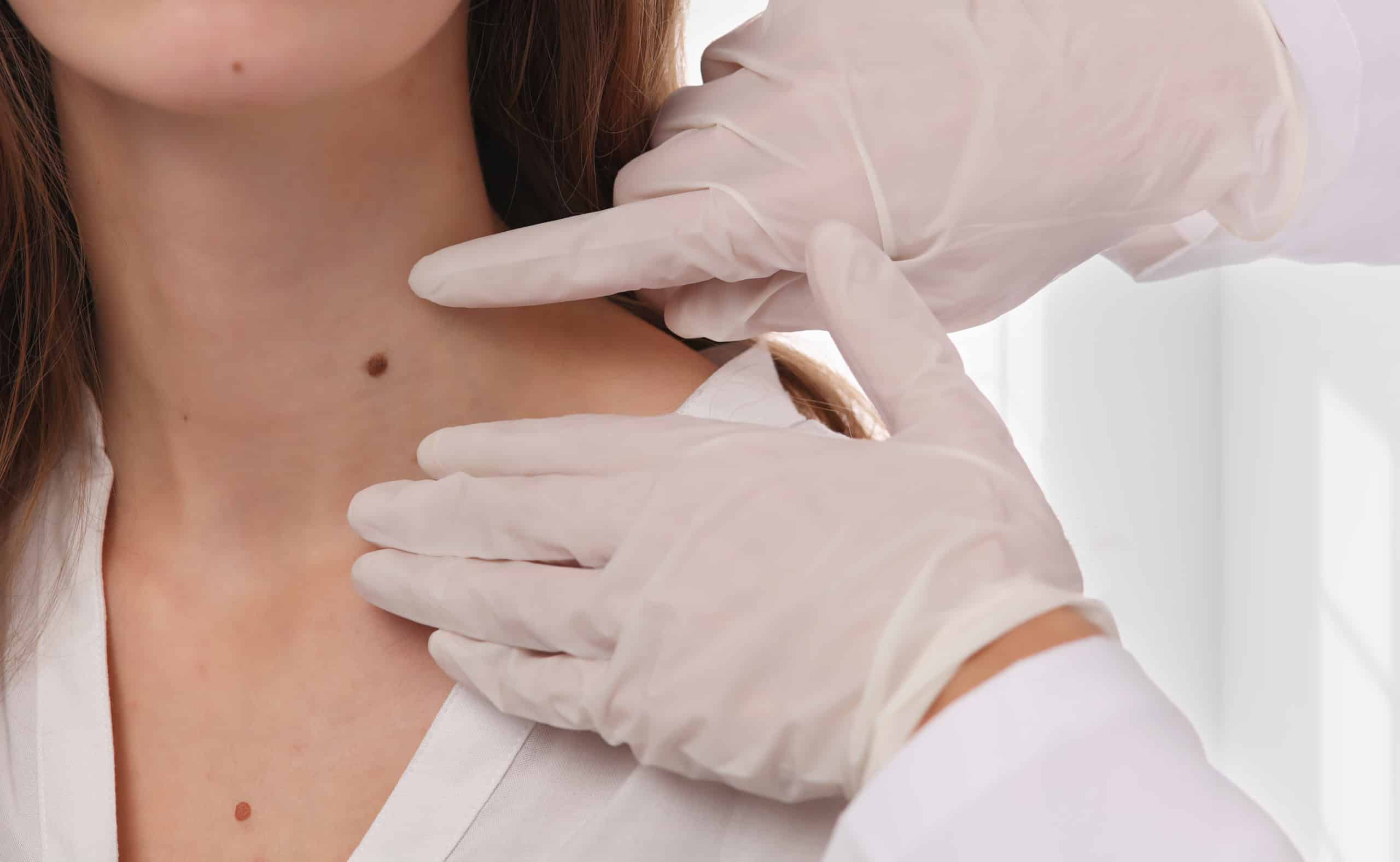 What Are Skin Tags, And How Do Doctors Treat These Tags?